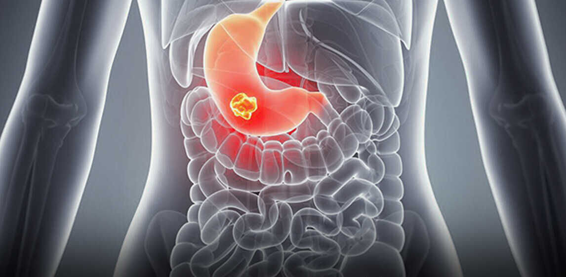 Carcinoid Tumour Symptoms Causes Diagnosis Treatment And Prevention