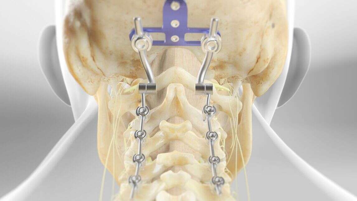 What is Cervical Spine Surgery: Meaning and Different Types
