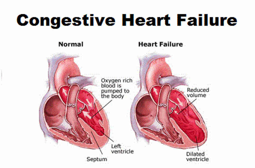 Congestive Heart Failure: Symptoms, Causes, Types, Treatment & Prevention
