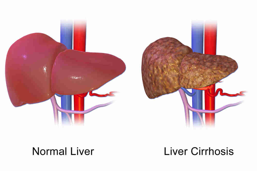 Liver Cirrhosis: Symptoms, Causes, Stages, Treatment & Prevention