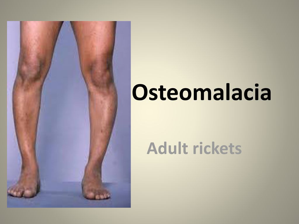 Osteomalacia In Adults