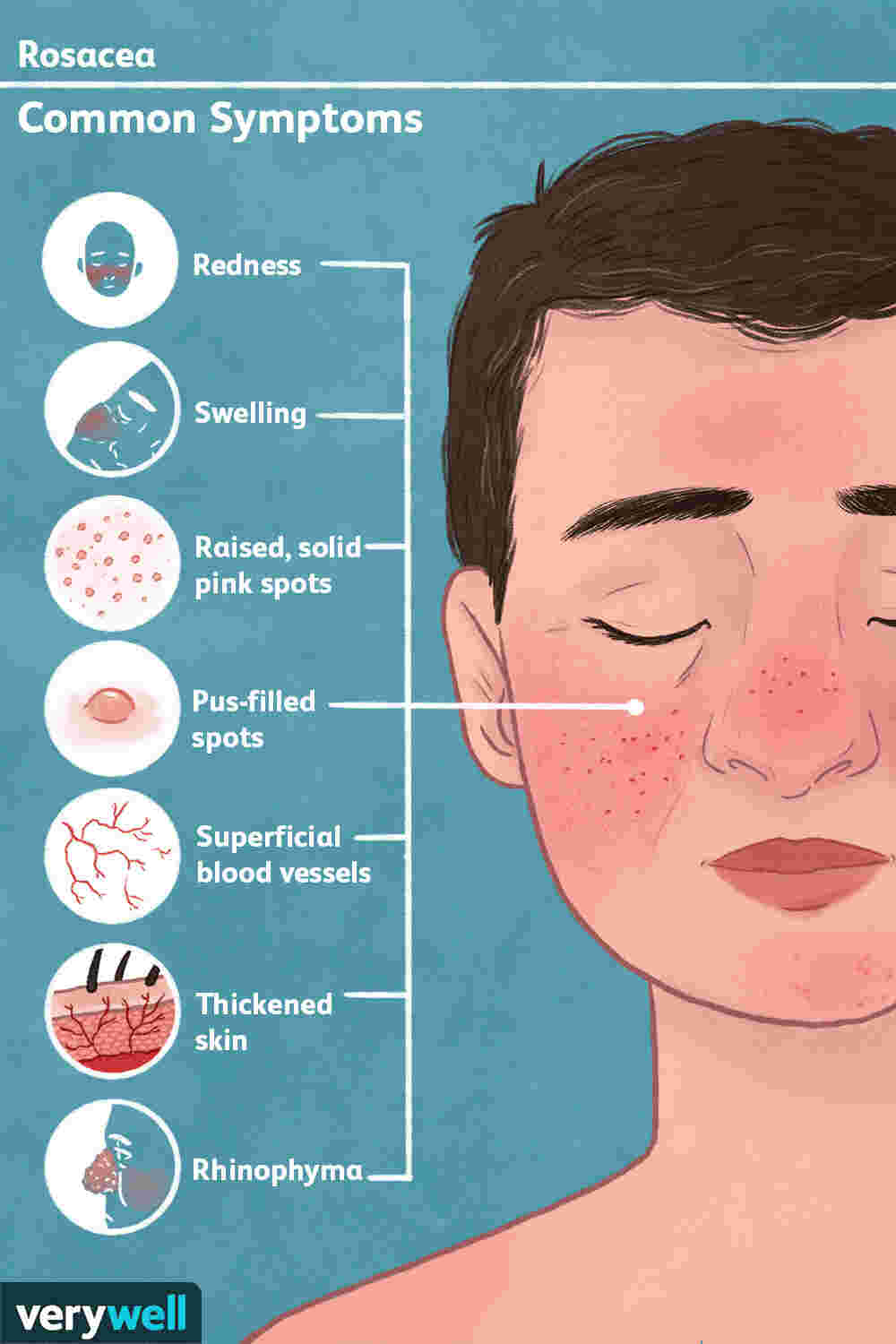 Symptoms Of Malaria On Skin
