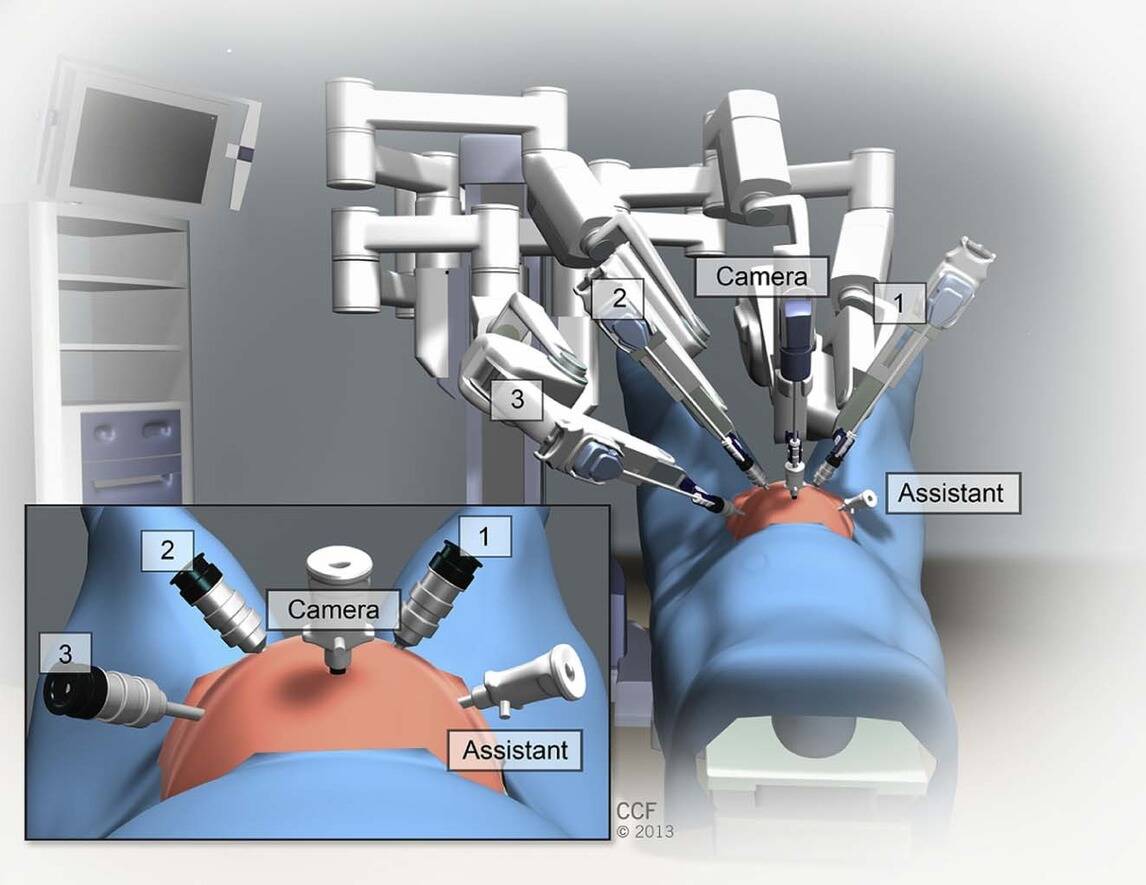 What is Robotic-Assisted Sacrocolpopexy & How It Is Helpful? a Detailed ...