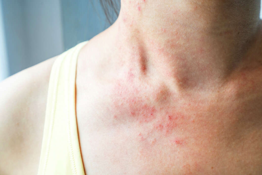 Skin Rashes: Symptoms, Causes, Types, Prevention & Treatment