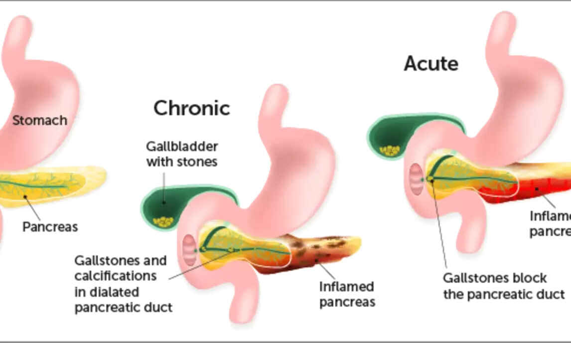 Chronic Pancreatitis : Symptoms, Causes, Treatment