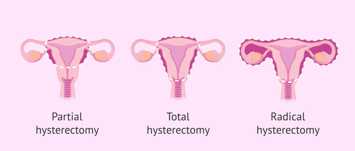 What is Hysterectomy: Hysterectomy Types, Procedure, Risks & Recovery