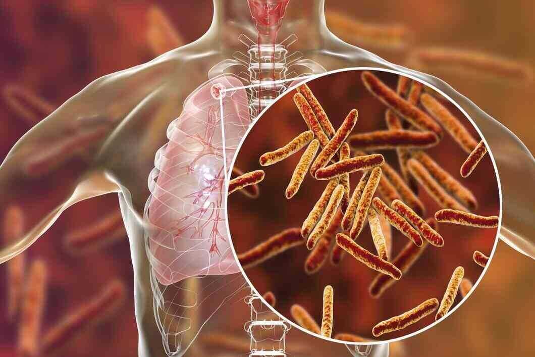 Tuberculosis: Symptoms, Causes, Treatment & Prevention